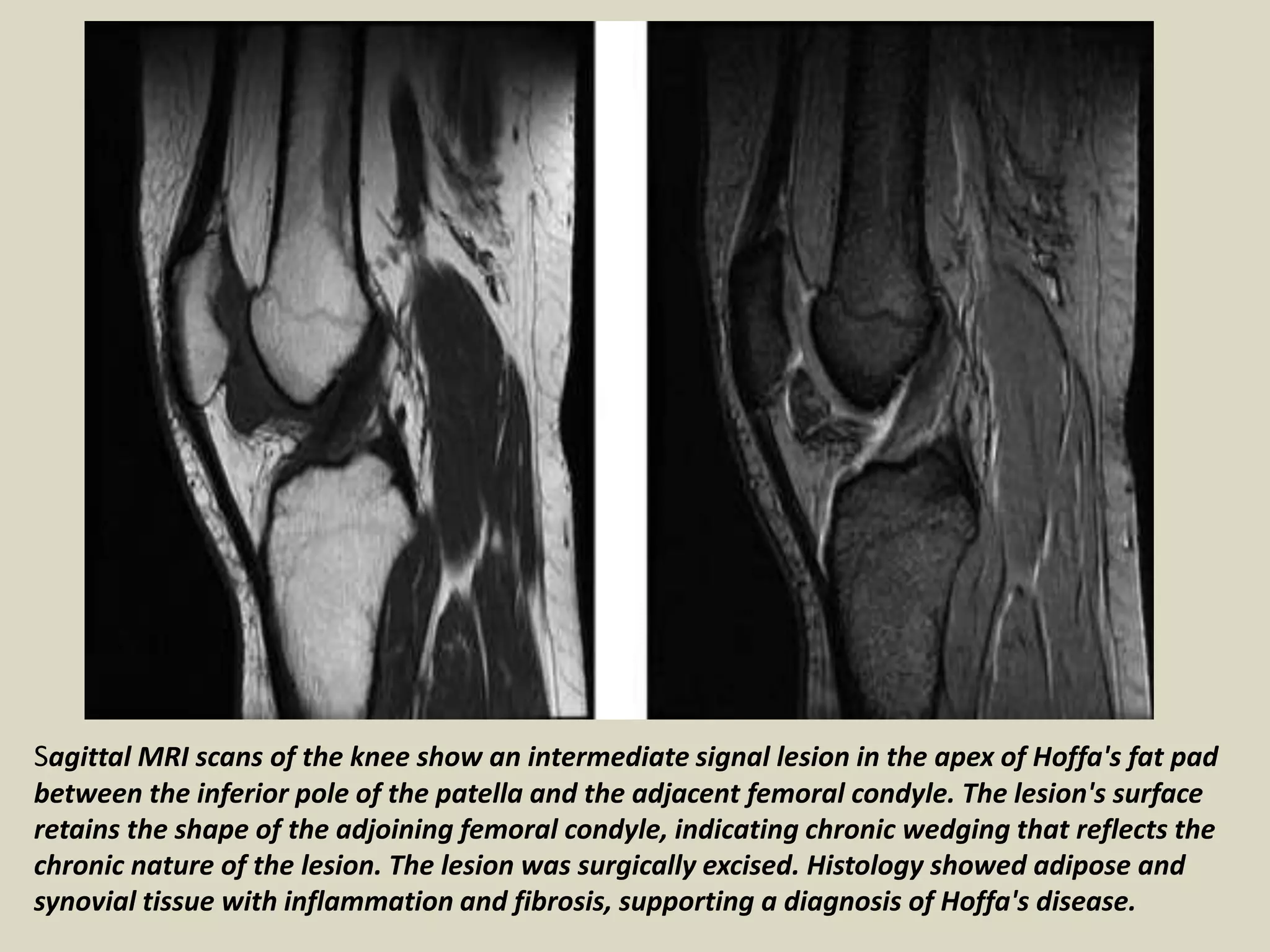 Presentation1, radiological imaging of anterior knee pain. | PPTX