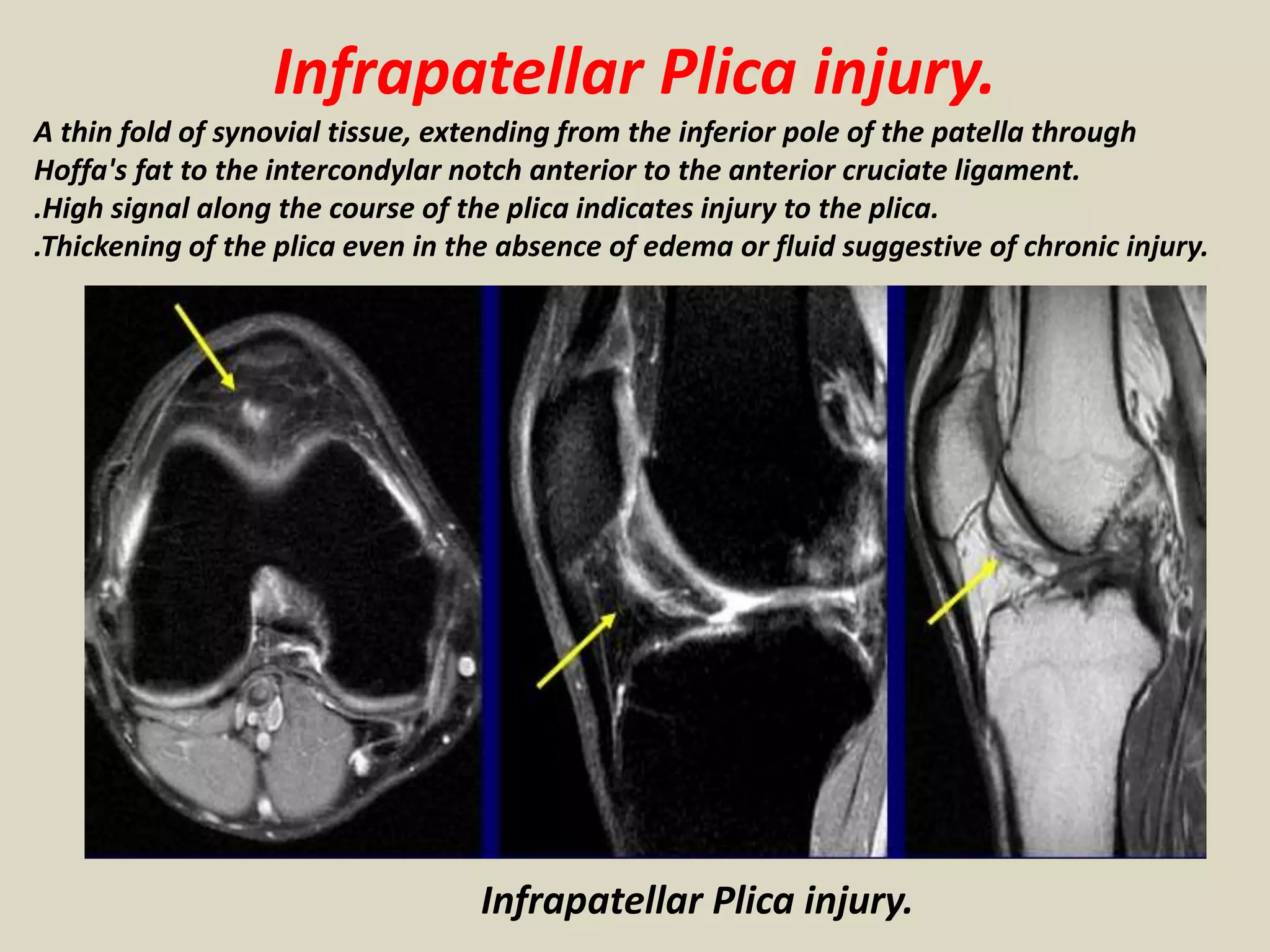 Presentation1, radiological imaging of anterior knee pain. | PPTX