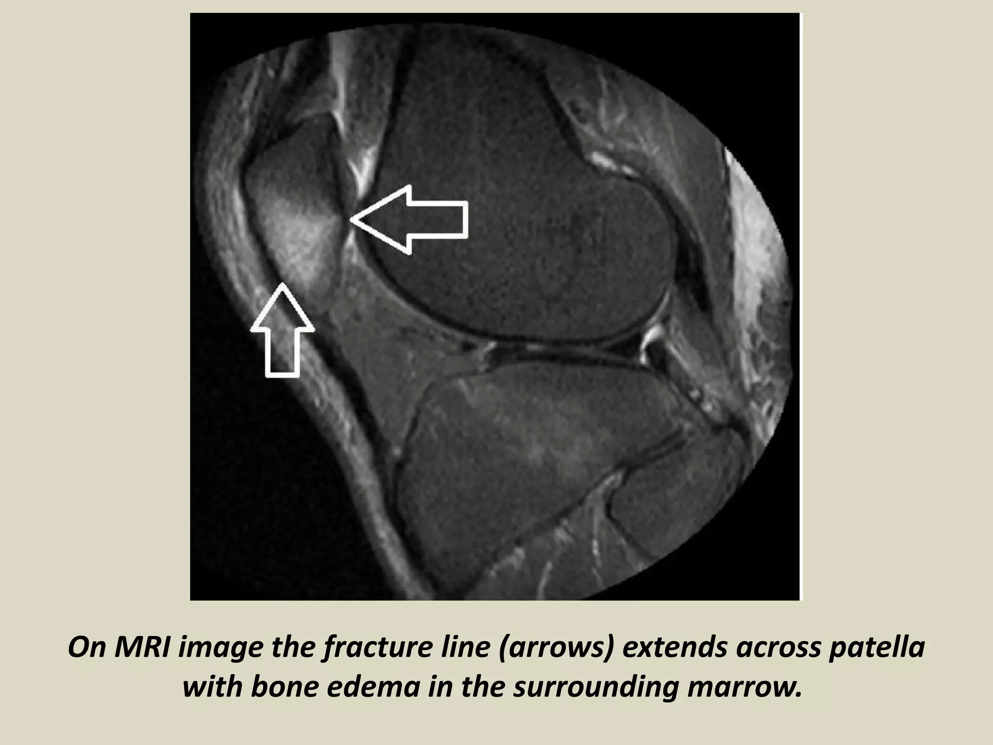 Presentation1, radiological imaging of anterior knee pain. | PPTX