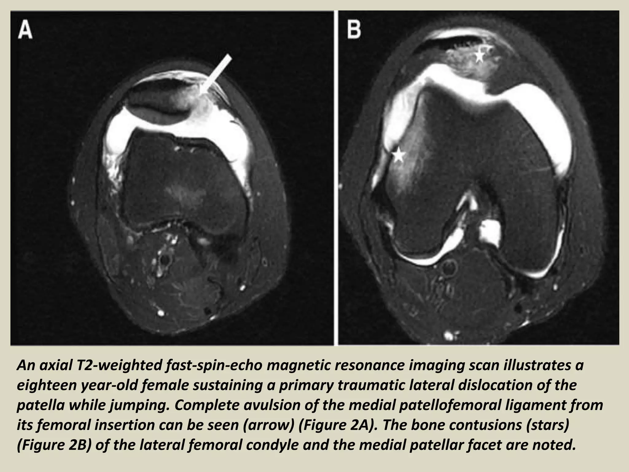 Presentation1, radiological imaging of anterior knee pain. | PPTX