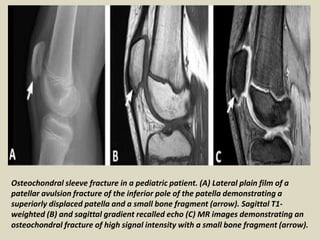 Presentation1, radiological imaging of anterior knee pain. | PPTX