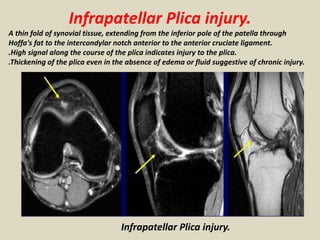 Presentation1, radiological imaging of anterior knee pain. | PPT