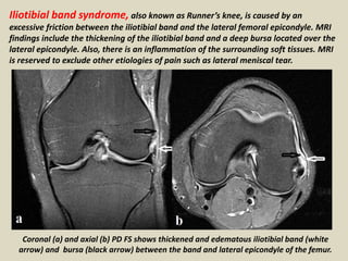 Iliotibial Band Syndrome Mri