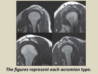 Acromion Types Mri