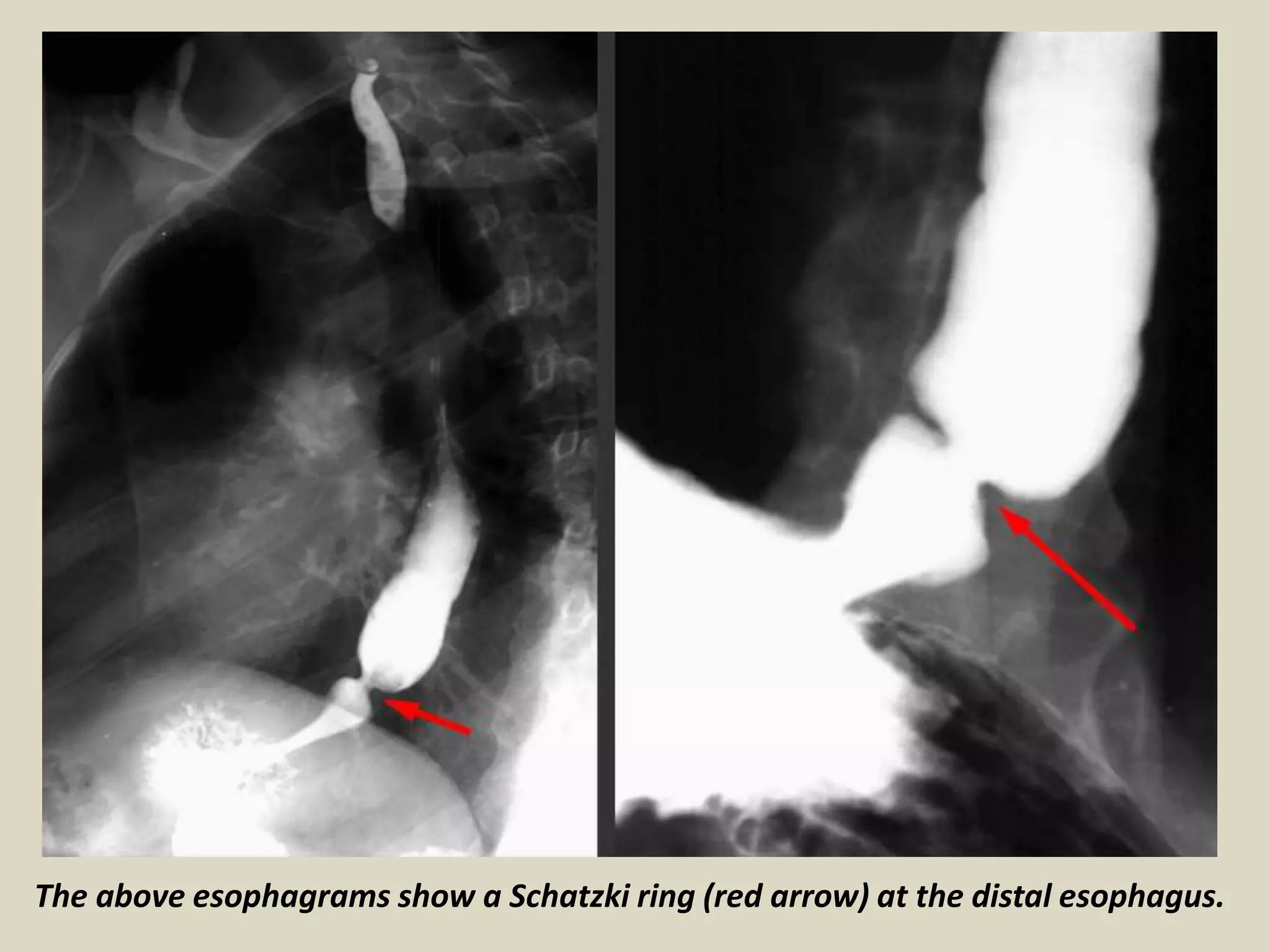 Presentation1, radiological imaging of barium studies. | PPTX