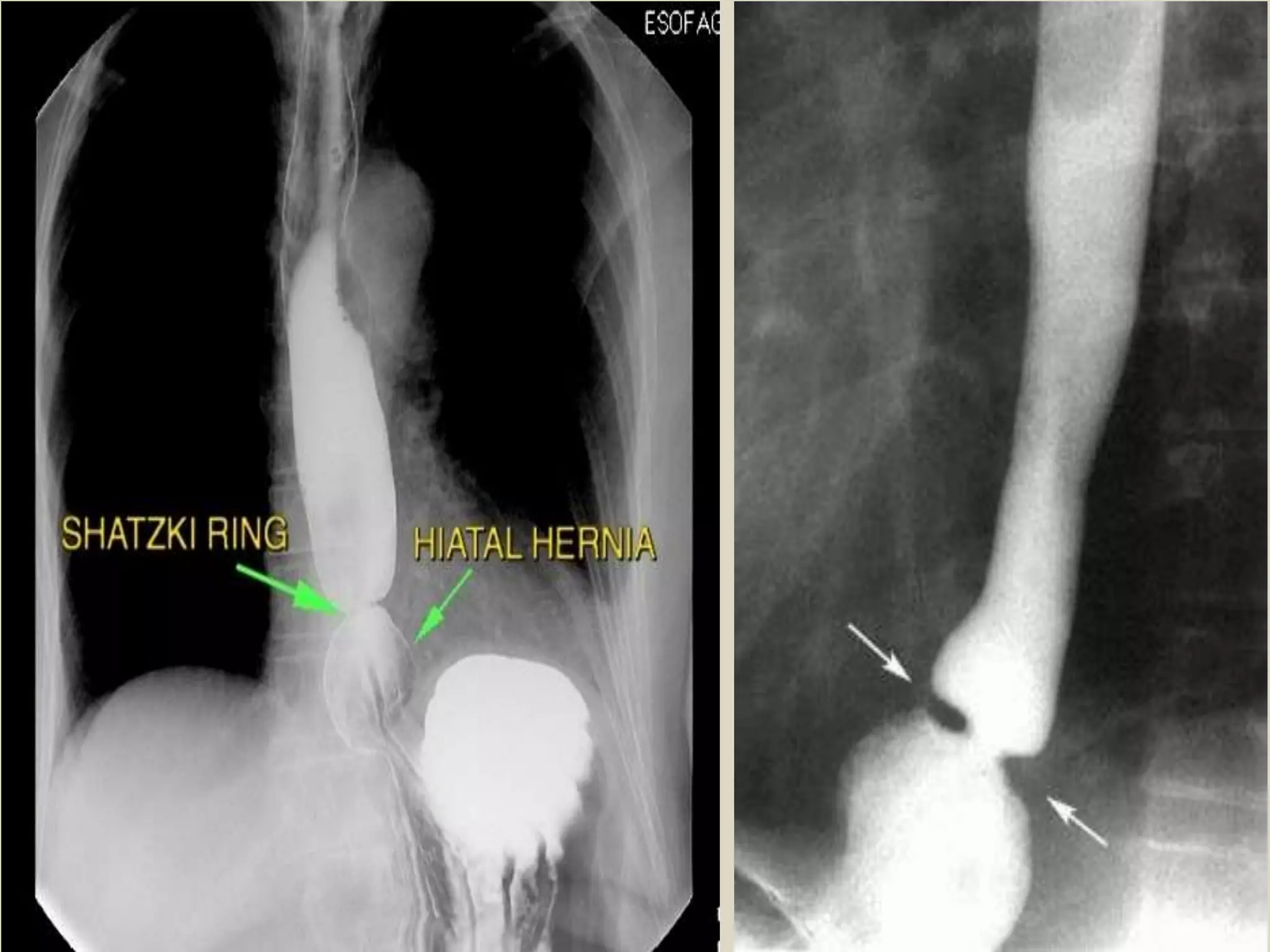 Presentation1, radiological imaging of barium studies. | PPTX
