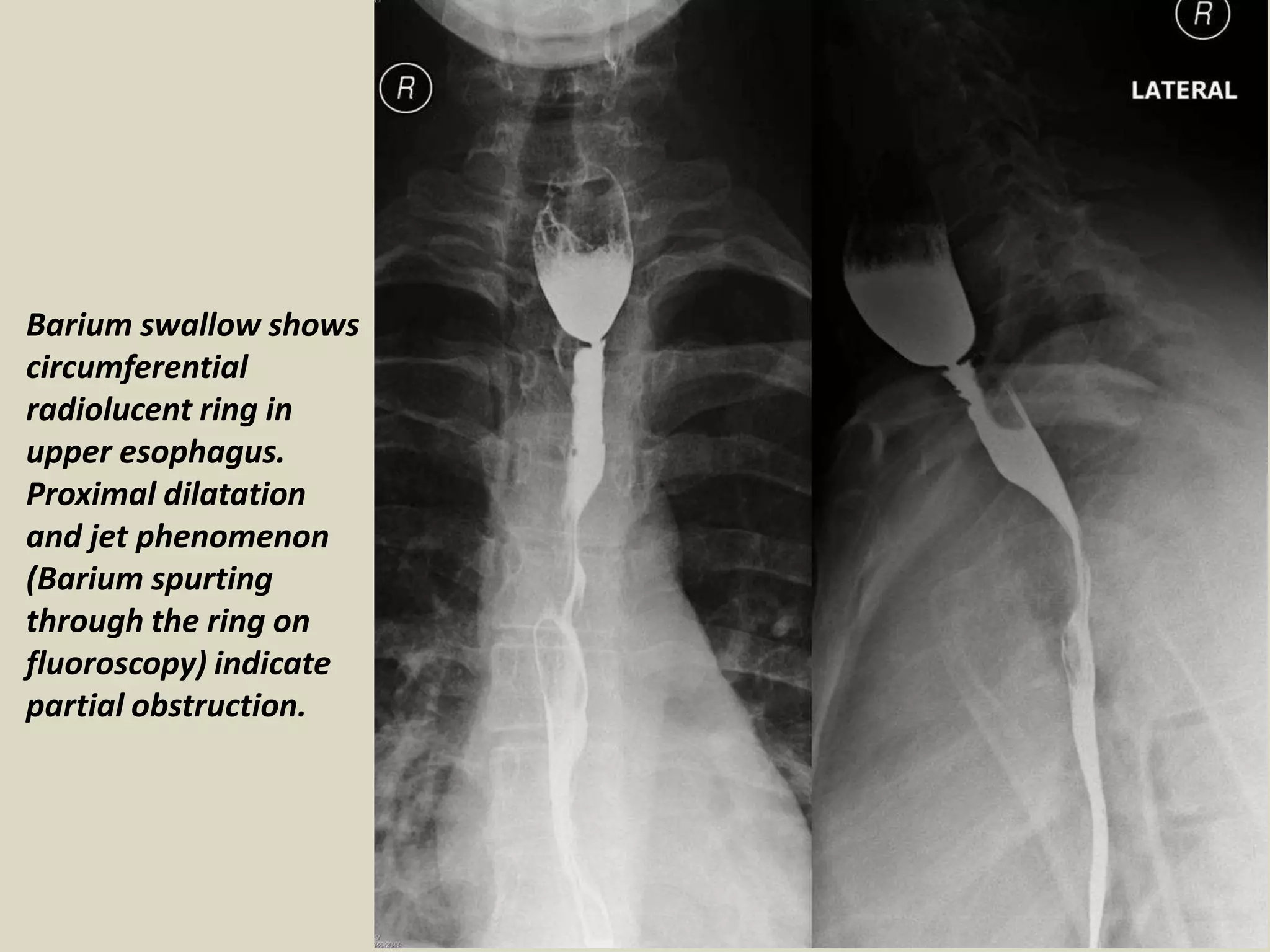 Presentation1, radiological imaging of barium studies. | PPTX ...