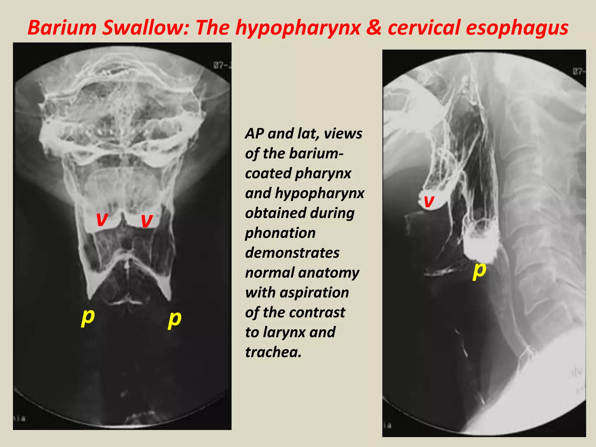 Presentation1, radiological imaging of barium studies. | PPTX