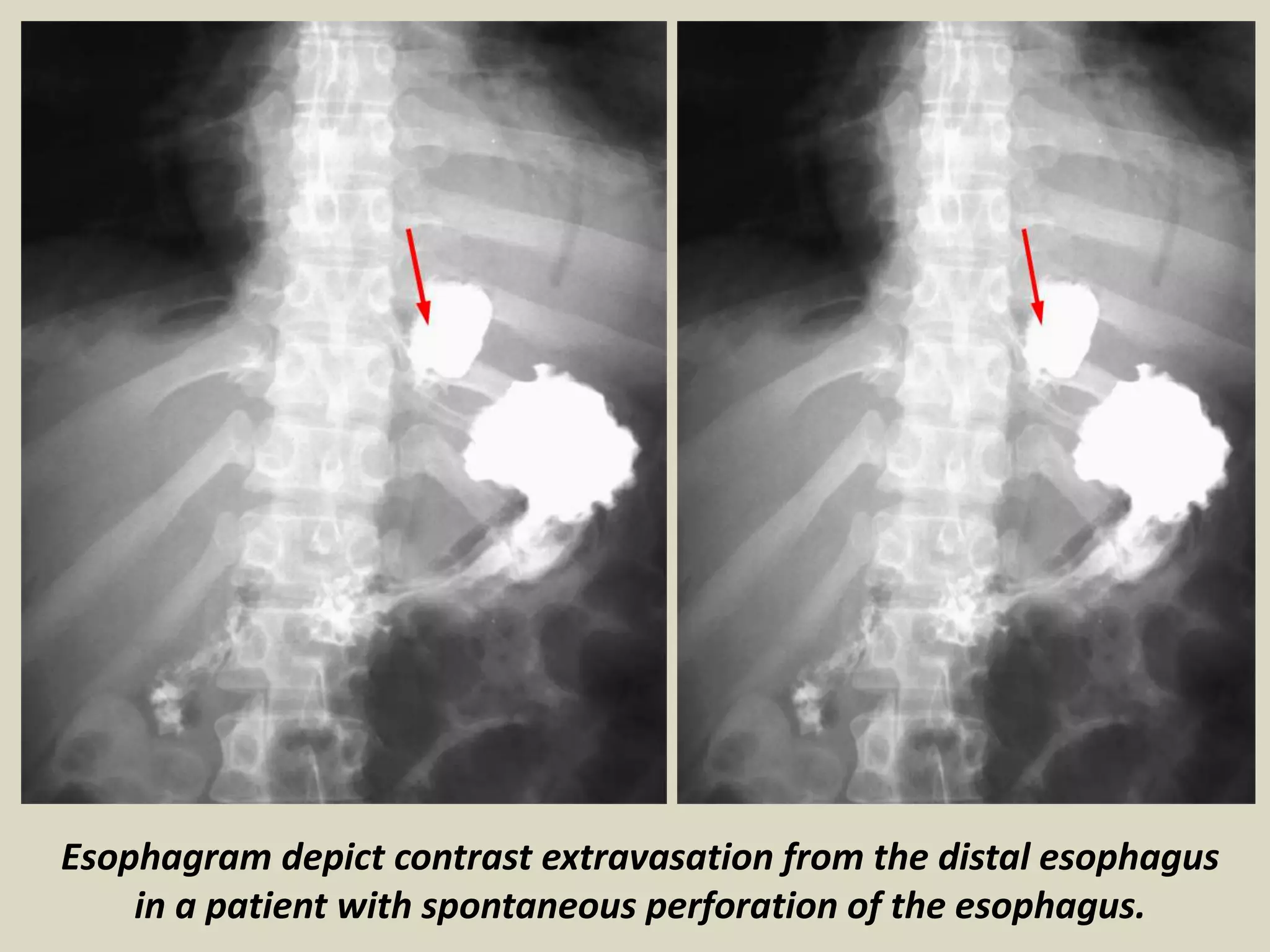 Presentation1, radiological imaging of barium studies. | PPTX