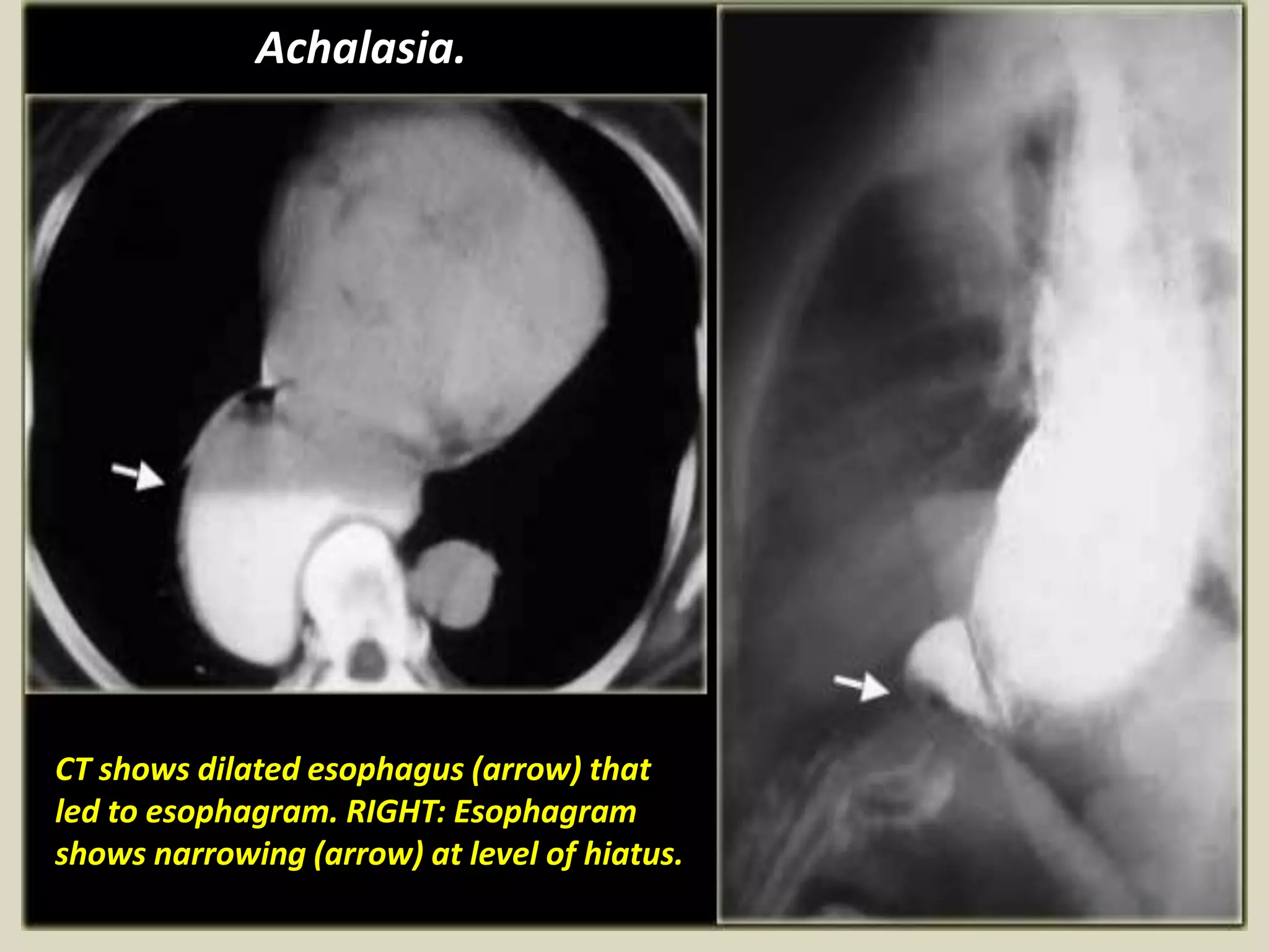 Presentation1, radiological imaging of barium studies. | PPTX