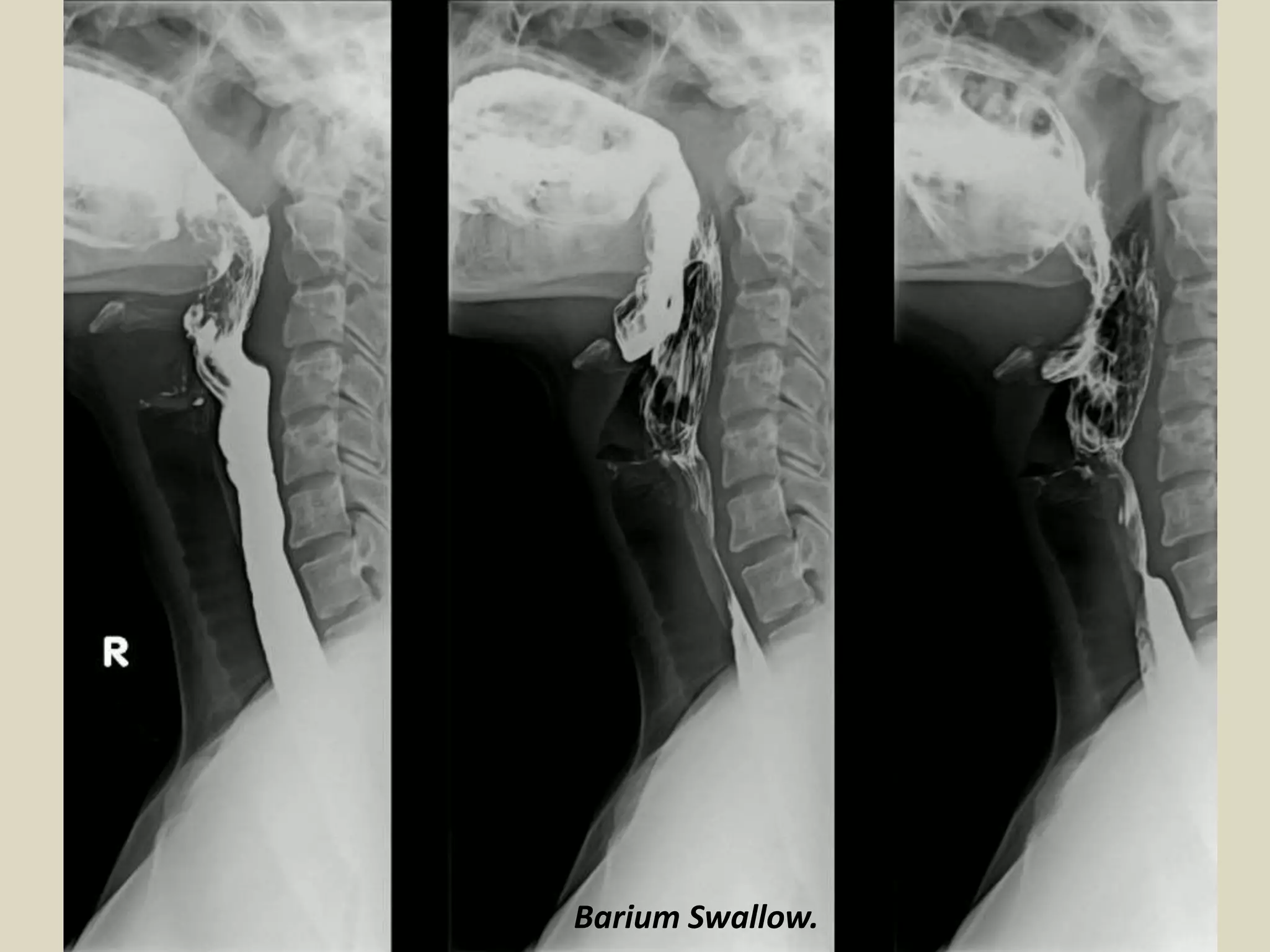 Presentation1, radiological imaging of barium studies. | PPTX