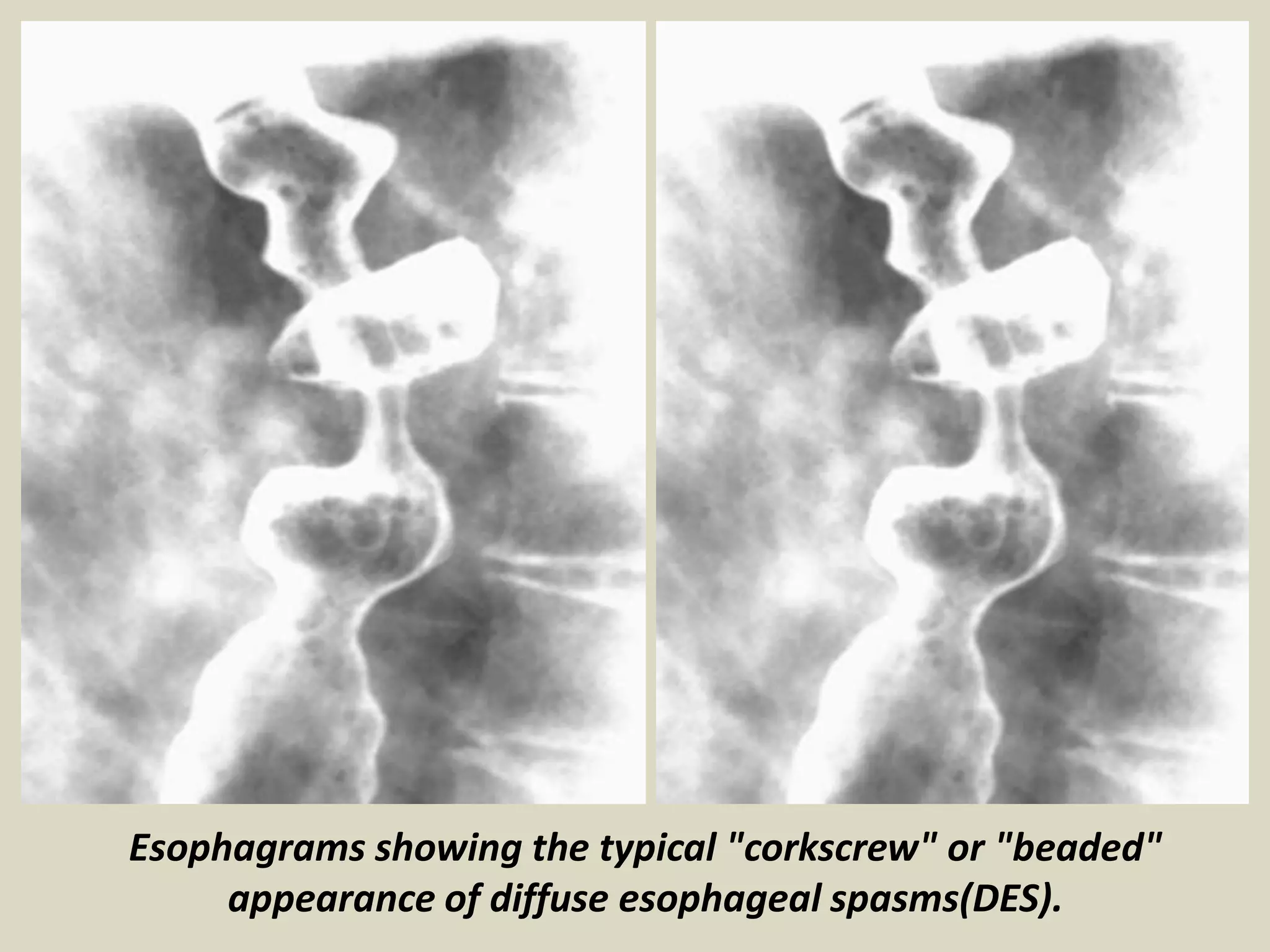 Presentation1, radiological imaging of barium studies. | PPTX ...