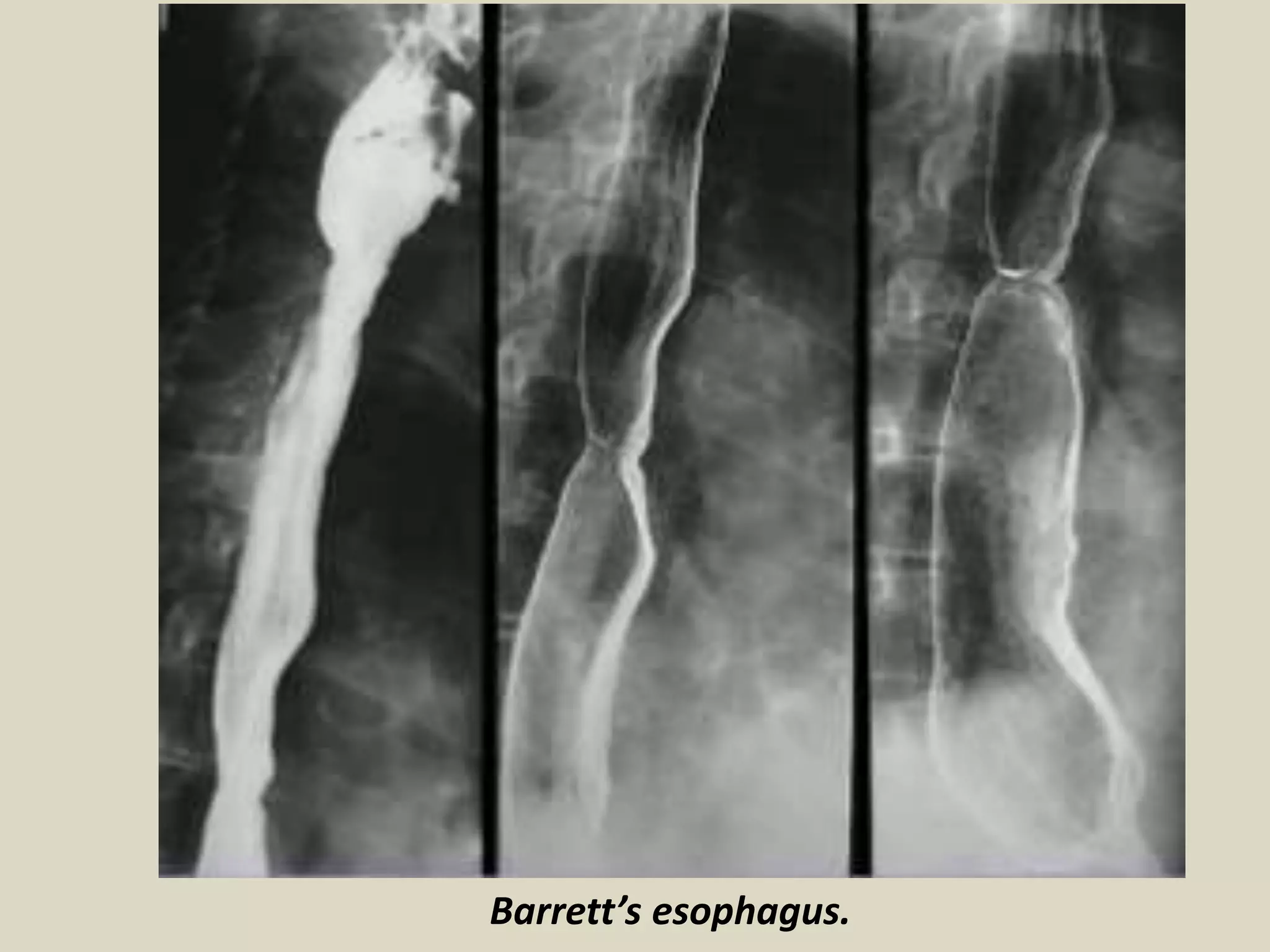 Presentation1, radiological imaging of barium studies. | PPTX