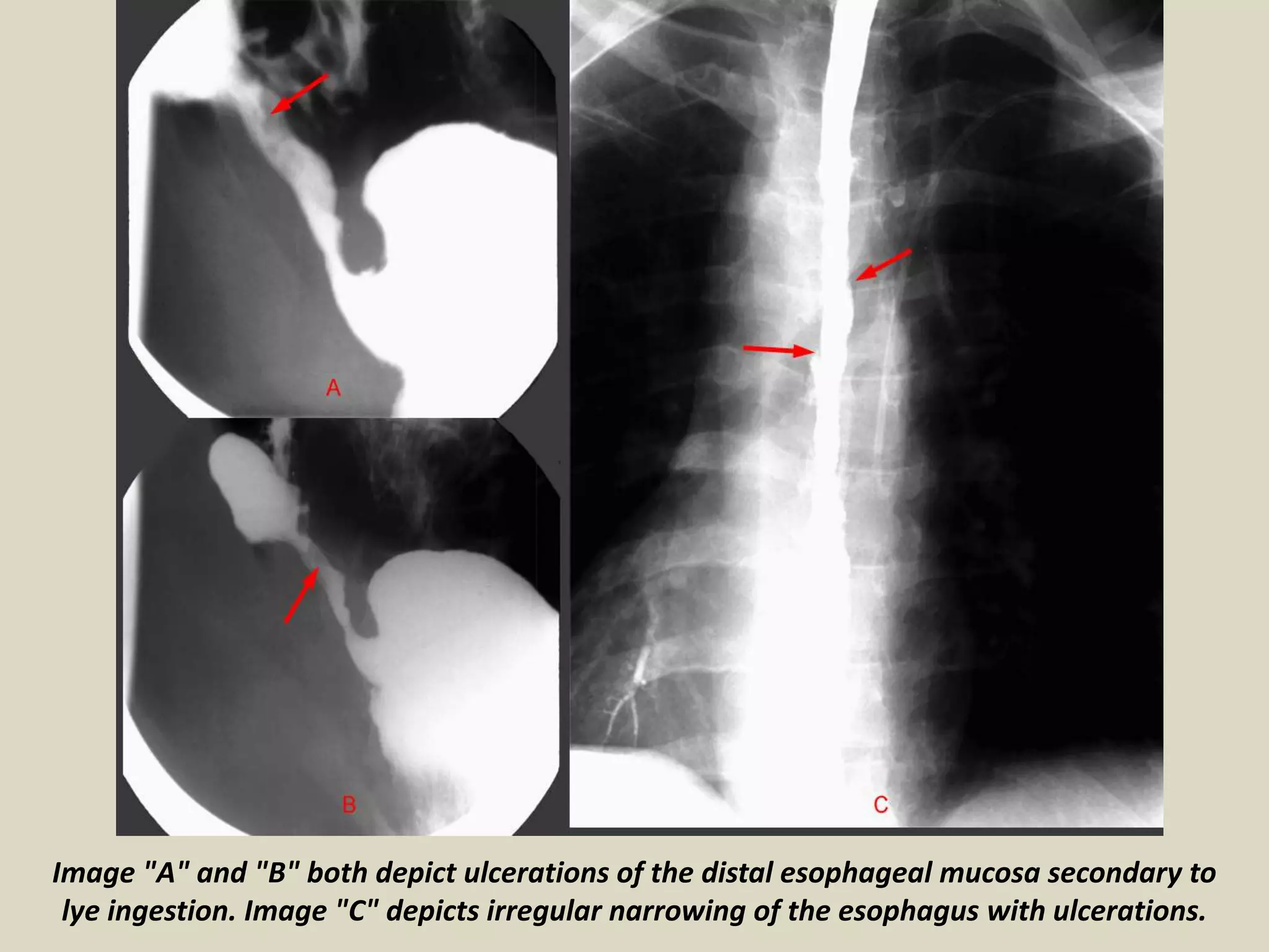 Presentation1, radiological imaging of barium studies. | PPTX