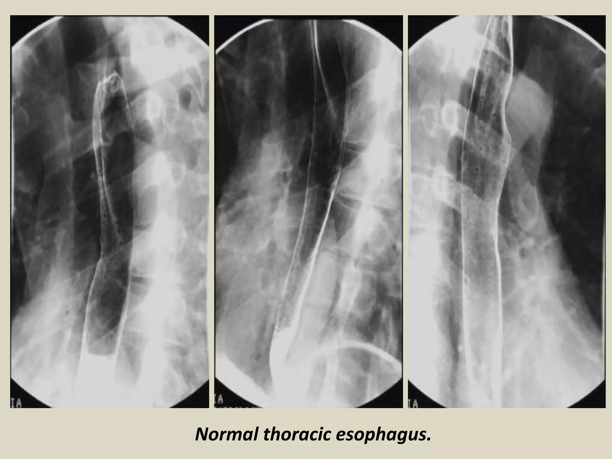 Presentation1, radiological imaging of barium studies. | PPTX