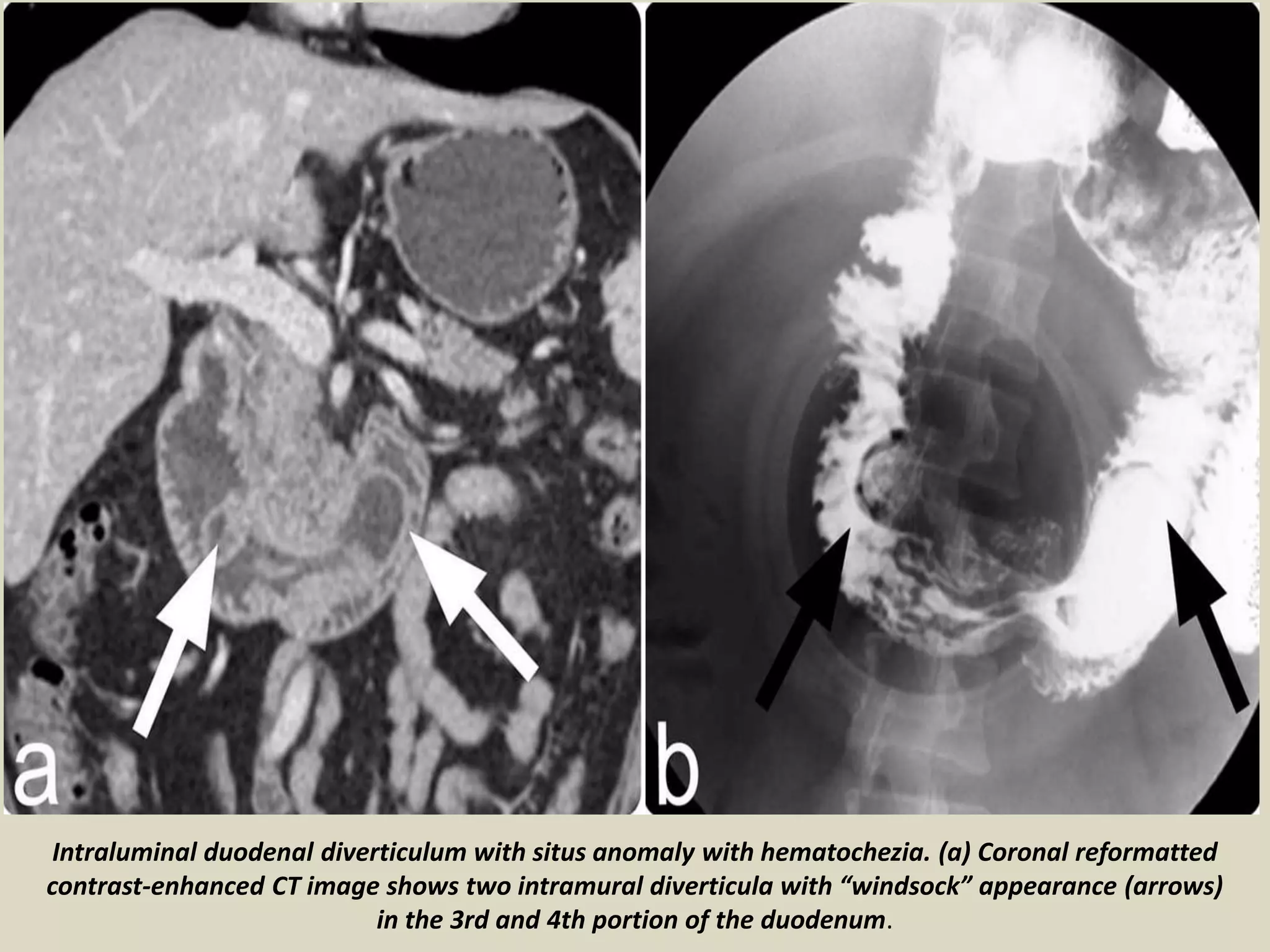 Presentation1, radiological imaging of barium studies.