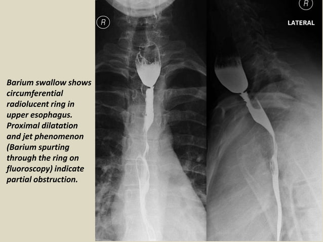 Presentation1, radiological imaging of barium studies. | PPTX ...