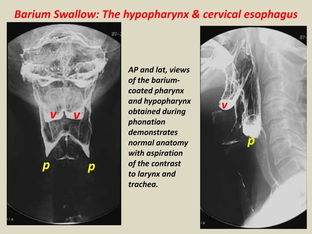 Presentation1, radiological imaging of barium studies. | PPTX ...