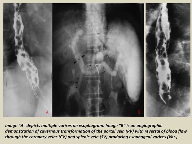 Presentation1, radiological imaging of barium studies. | PPTX ...