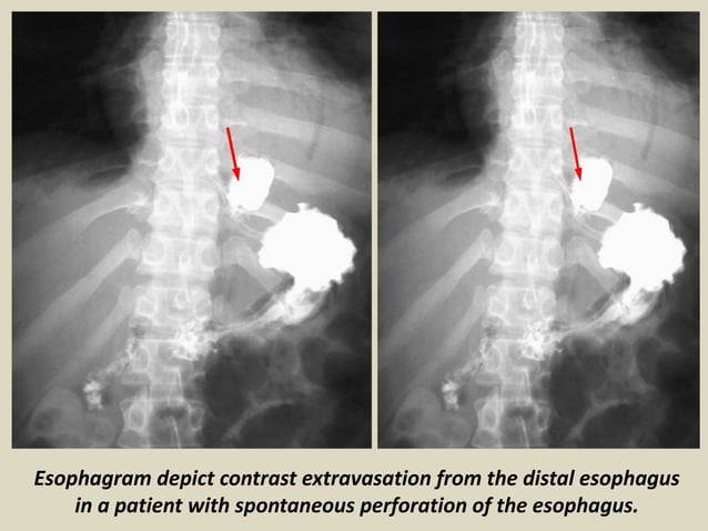 Presentation1, radiological imaging of barium studies. | PPTX ...