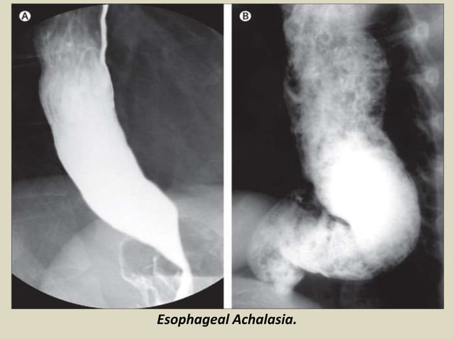 Presentation1, radiological imaging of barium studies. | PPTX ...