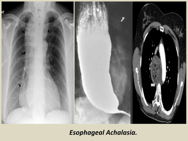 Presentation1, radiological imaging of barium studies. | PPTX ...
