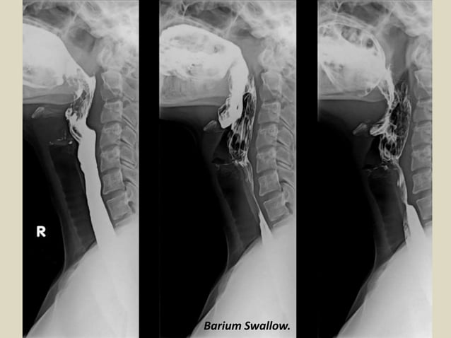 Presentation1, radiological imaging of barium studies. | PPTX ...