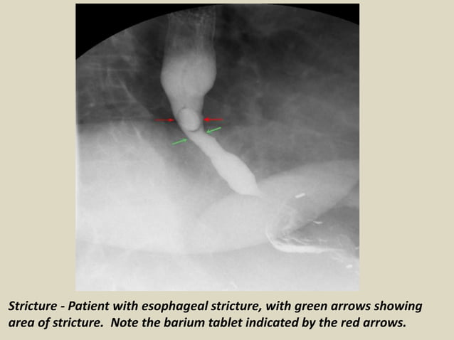 Presentation1, radiological imaging of barium studies. | PPTX ...