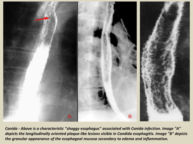 Presentation1, radiological imaging of barium studies. | PPTX ...