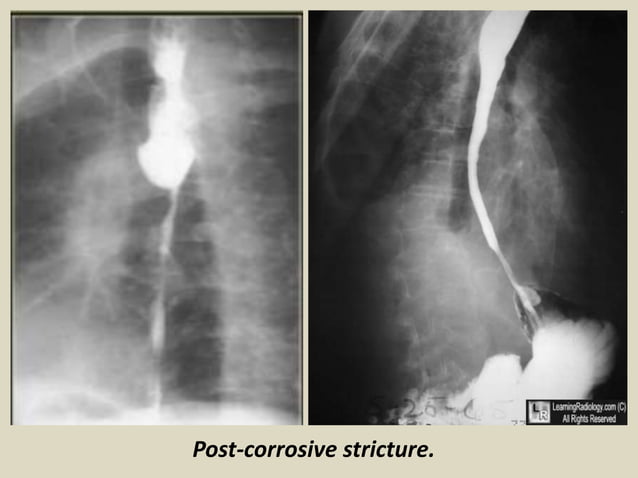 Presentation1, radiological imaging of barium studies. | PPTX ...