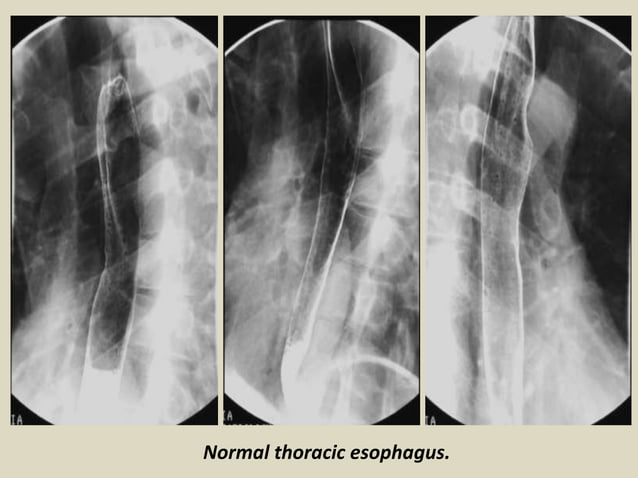 Presentation1, radiological imaging of barium studies. | PPTX ...