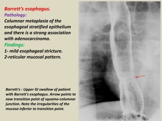 Presentation1, radiological imaging of barium studies. | PPT
