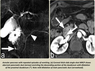 Annular Pancreas Barium