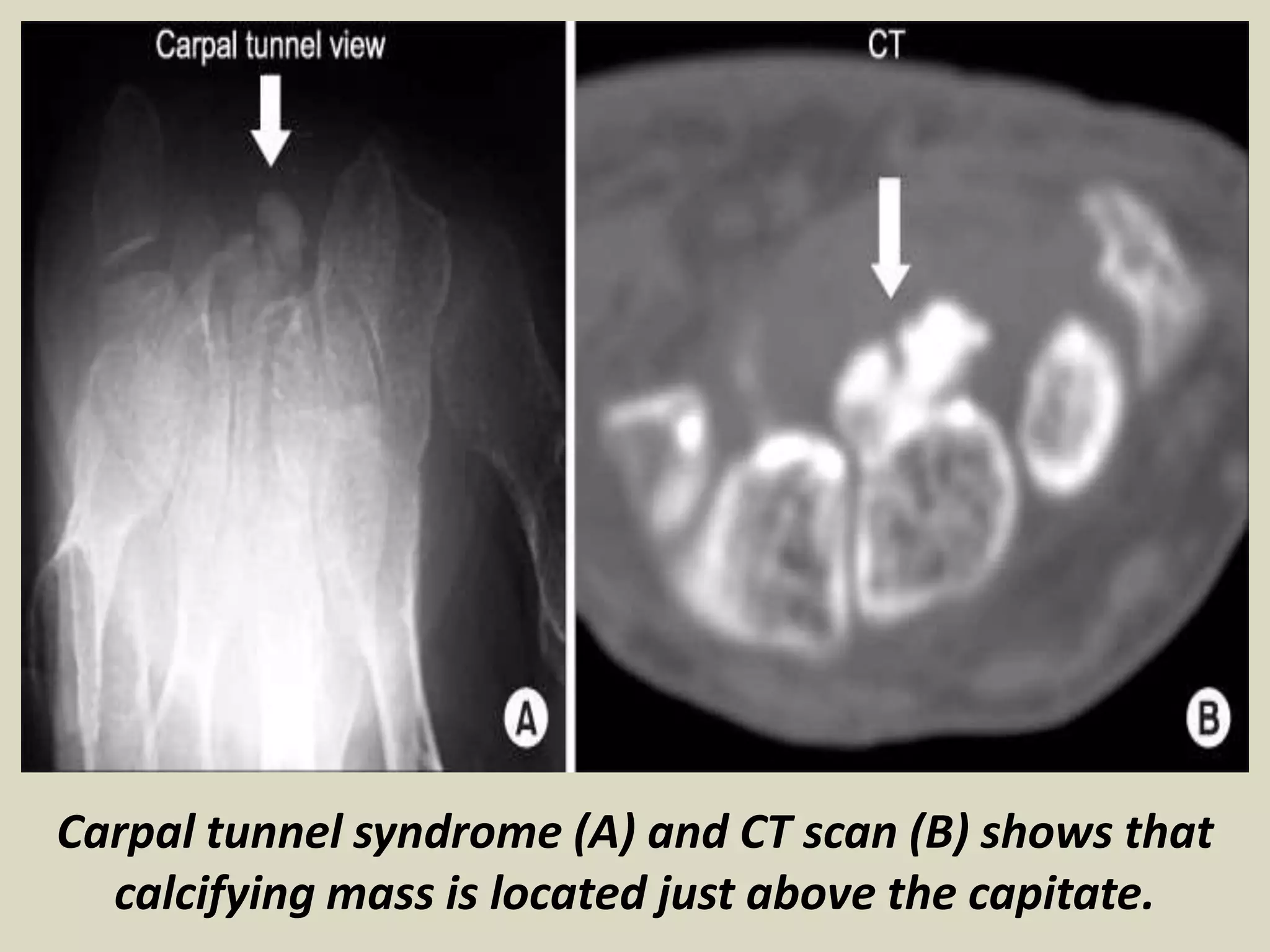 Presentation1 radiological imaging of carpal tunnel syndrome. | PPTX