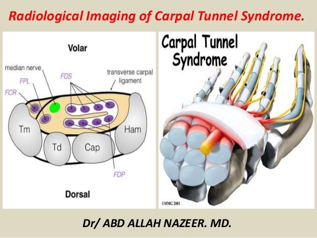Carpal Tunnel Radiology | Carpal Tunnel Syndrome – OVMN