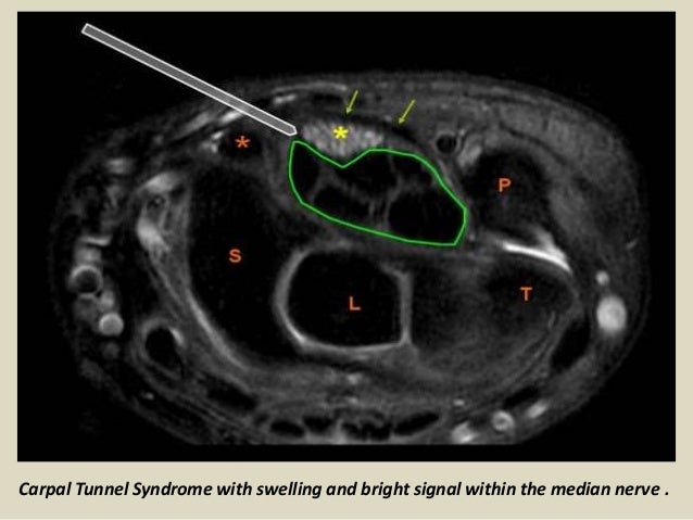 Presentation1 radiological imaging of carpal tunnel syndrome.