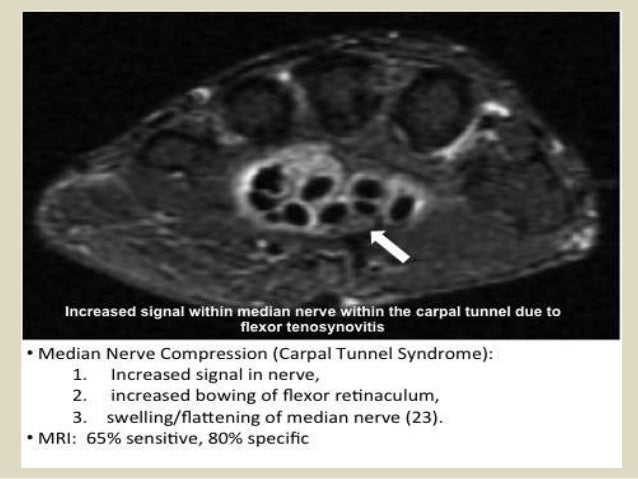 Presentation1 radiological imaging of carpal tunnel syndrome.