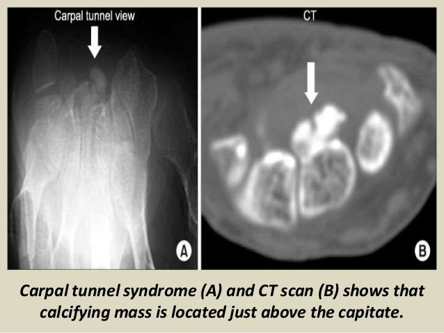 Presentation1 radiological imaging of carpal tunnel syndrome.
