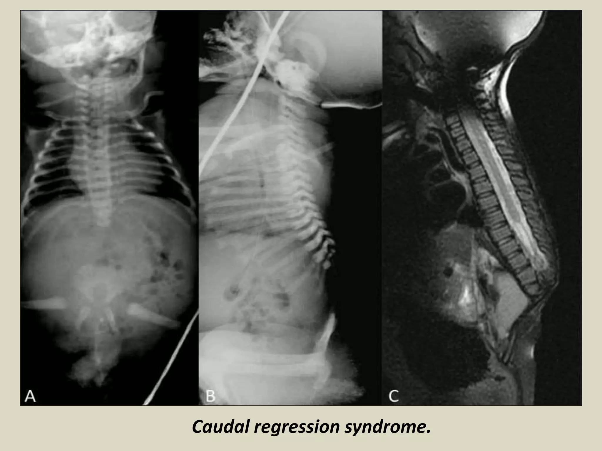 Presentation1, radiological imaging of caudal regression syndrome. | PPTX