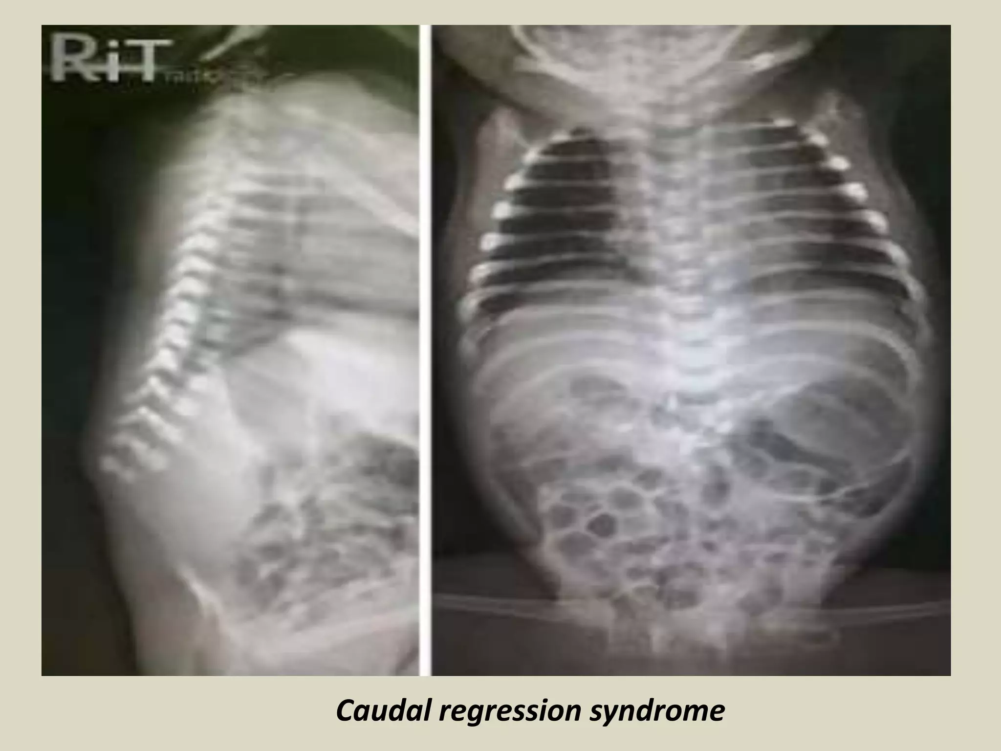 Presentation1, radiological imaging of caudal regression syndrome. | PPTX