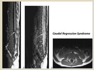 Presentation1, radiological imaging of caudal regression syndrome. | PPTX