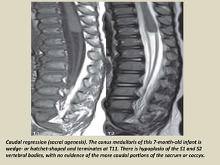Presentation1, radiological imaging of caudal regression syndrome. | PPT