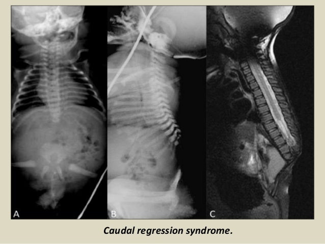 Presentation1, radiological imaging of caudal regression syndrome.