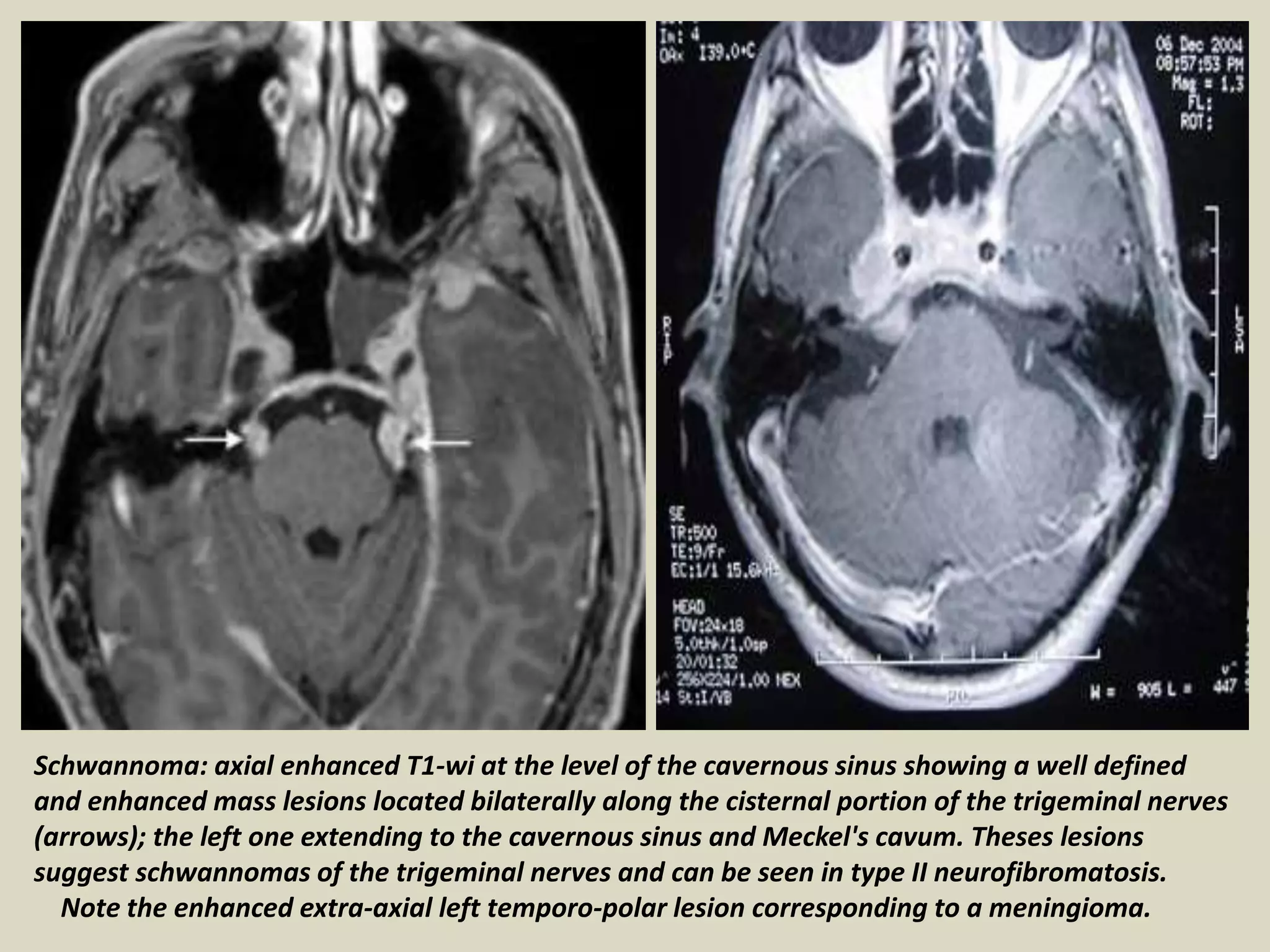 Presentation1, radiological imaging of cavernous sinus lesions. | PPT