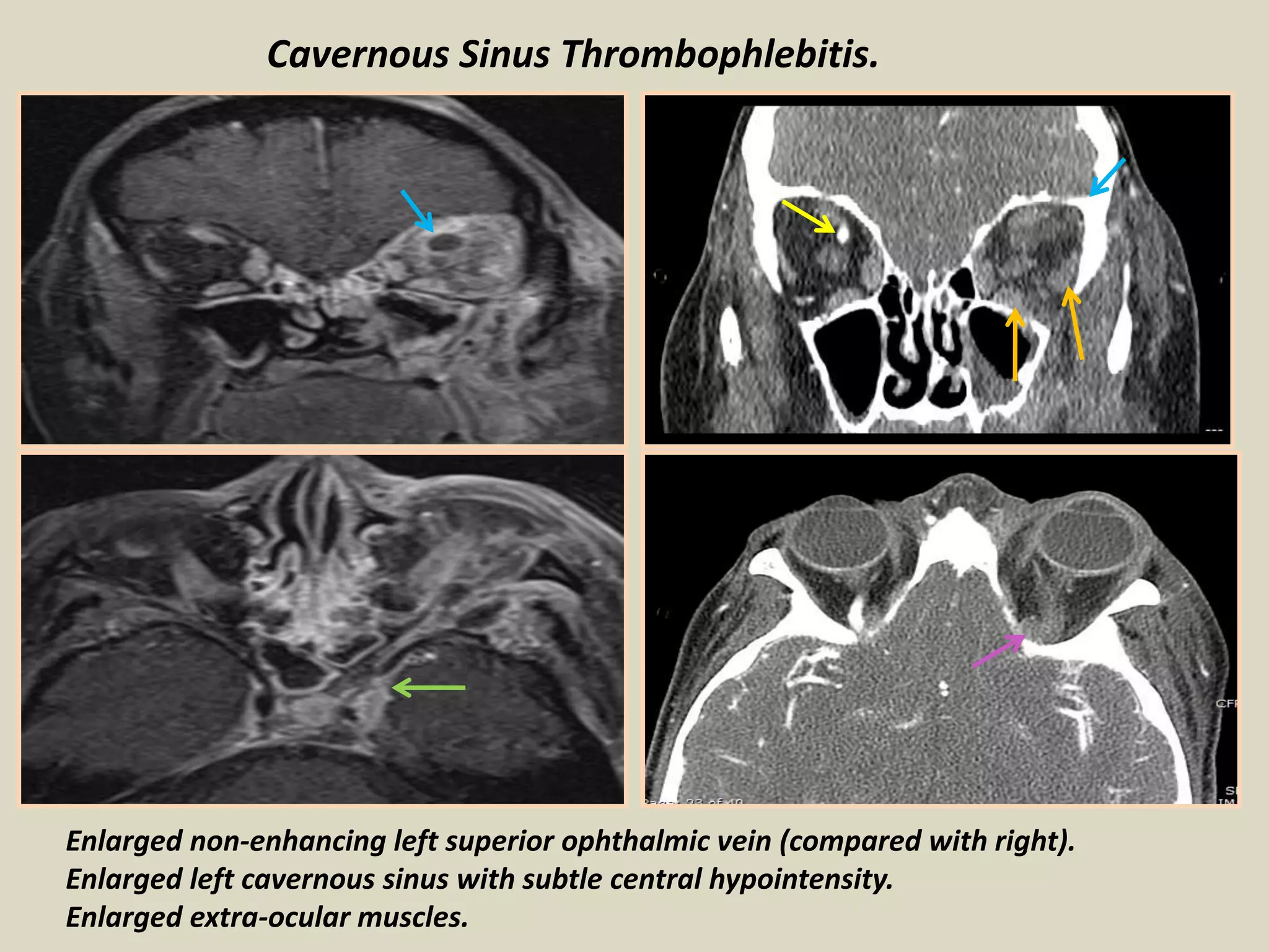 Presentation1, radiological imaging of cavernous sinus lesions. | PPTX ...