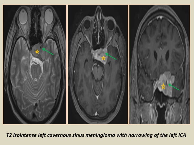 Presentation1, radiological imaging of cavernous sinus lesions. | PPTX ...