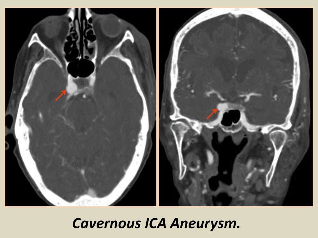 Presentation1, radiological imaging of cavernous sinus lesions.