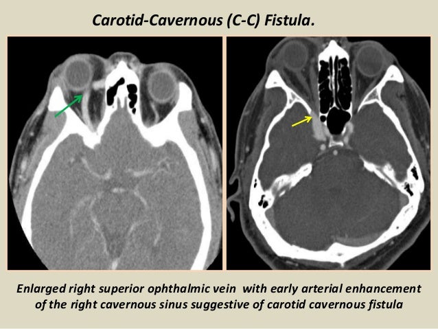 Presentation1, radiological imaging of cavernous sinus lesions.