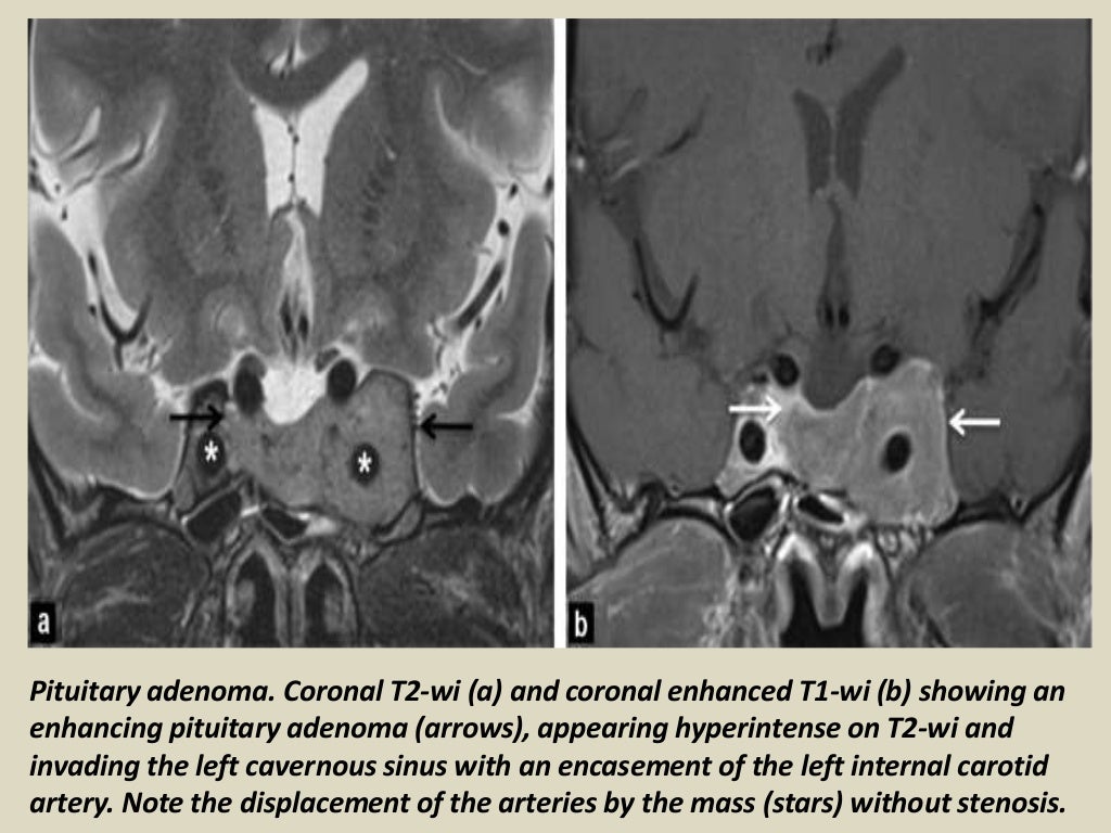Presentation1, radiological imaging of cavernous sinus lesions.