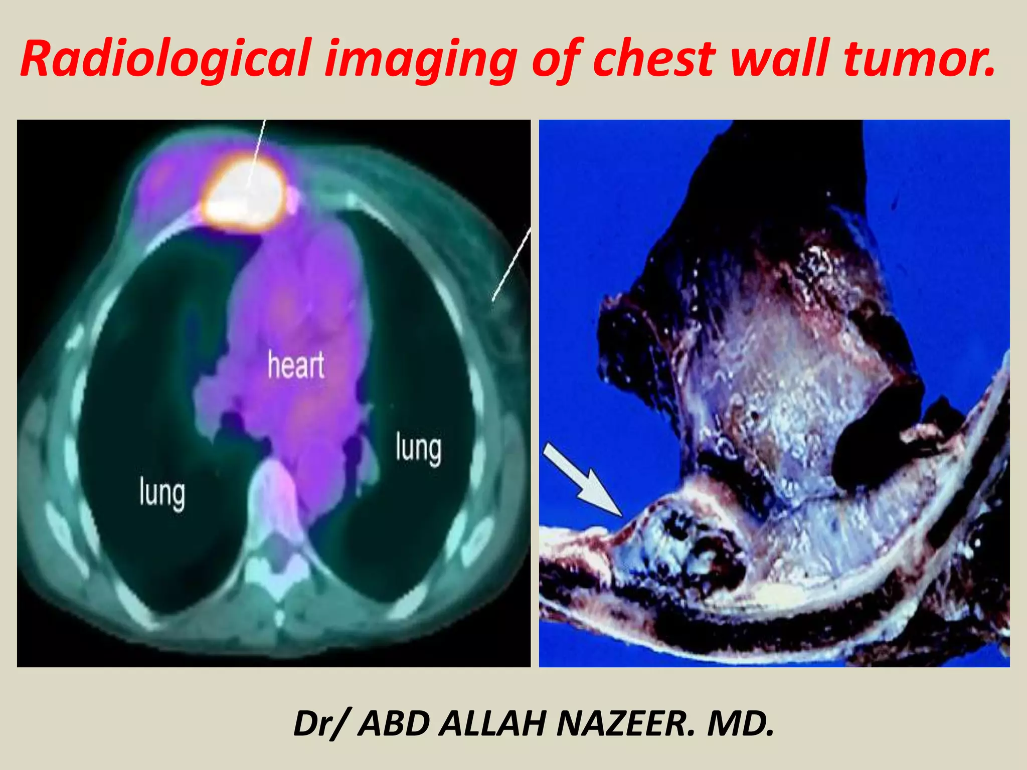 Presentation1, radiological imaging of chest wall tumour. | PPTX